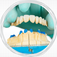 What Is A Dental Bridge? | Modern Smiles | Expert Care